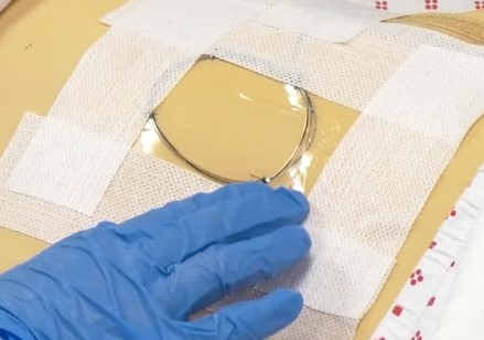 Film: Tunnelert spinal -og epidural kateter - stell - Kompetansebroen